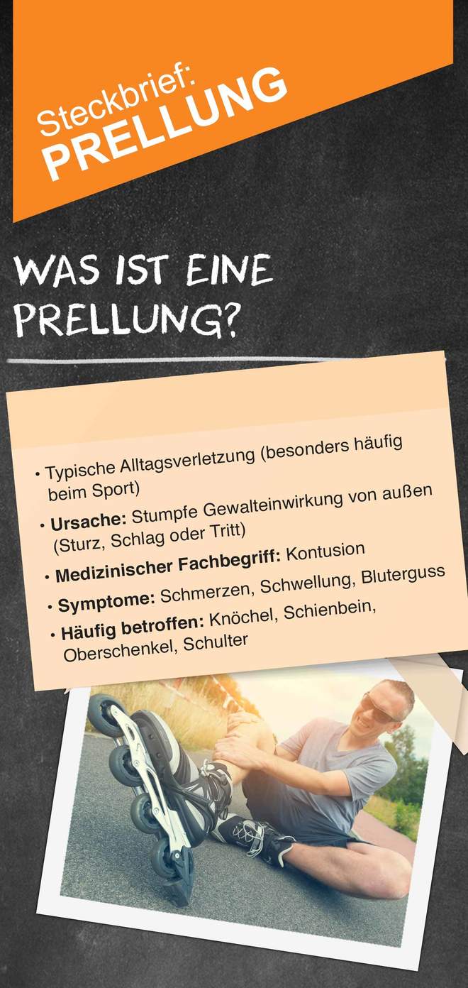 prellungen-infografik | Prellung